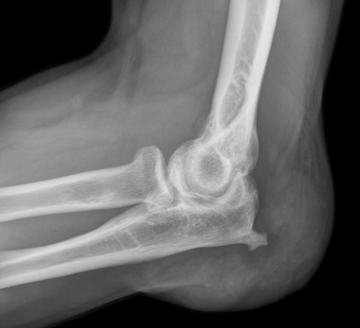 Bursitis Inflamación En Codo Rodillas Hombro O Cadera